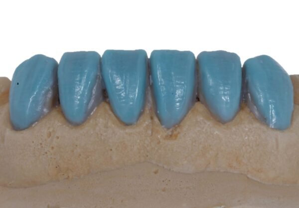 Qué son las Carillas Dentales y Resinas Inyectadas - Dentinela