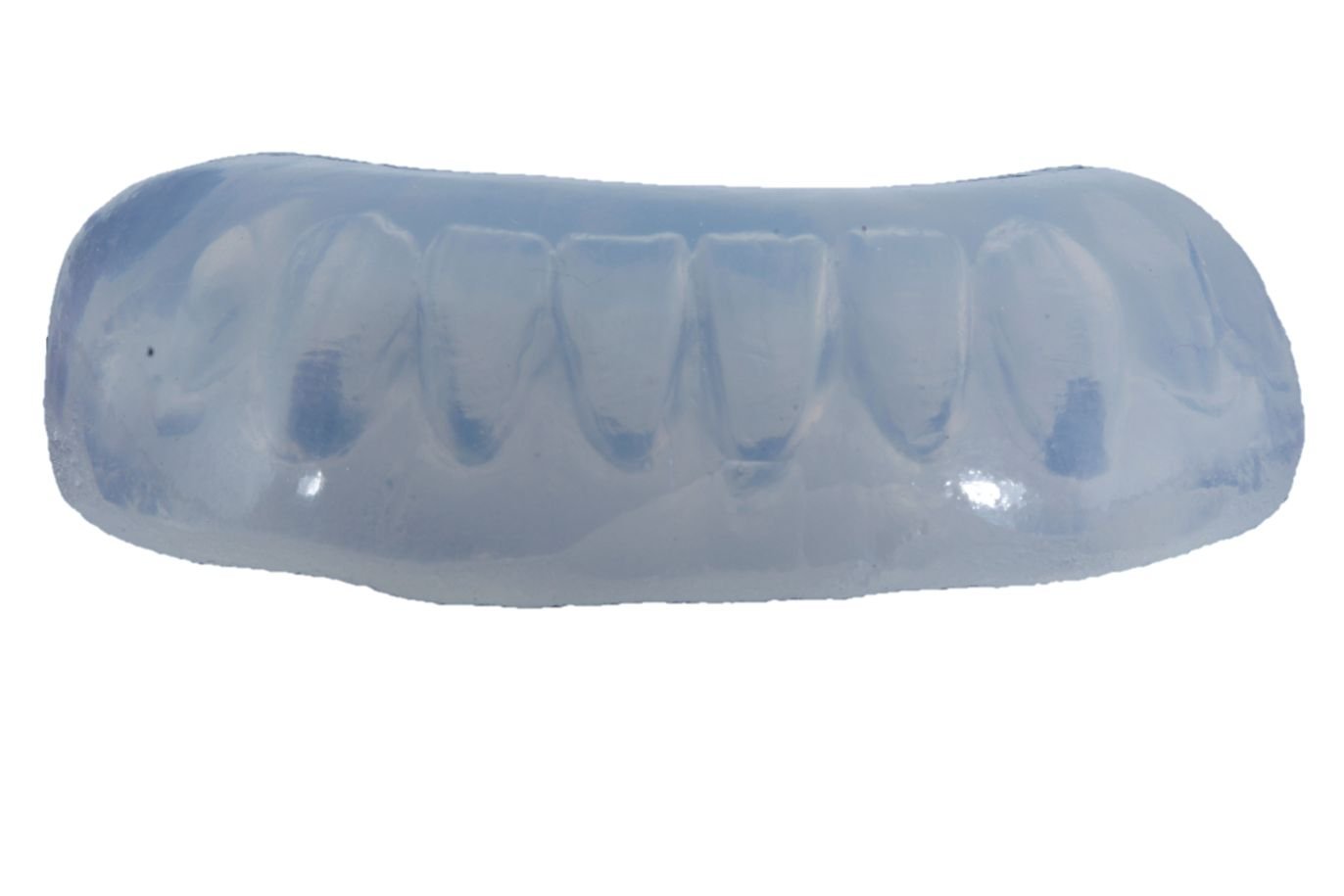 Qué son las Carillas Dentales y Resinas Inyectadas - Dentinela